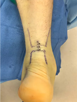 Minimally Invasive Foot Surgery Tacoma, WA | Foot Specialist Seattle, WA