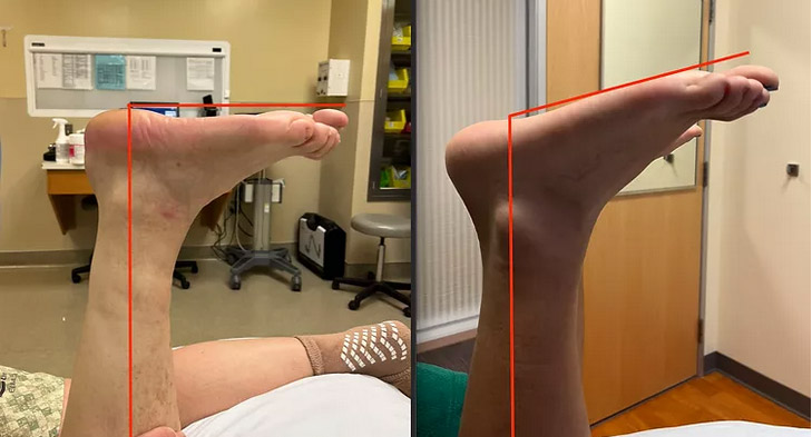 Achilles Tendon Rupture Seattle, WA | Achilles Tendon Tear Seattle, WA