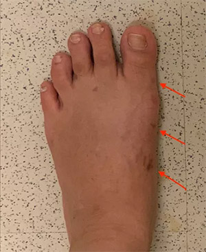 Minimally Invasive Foot Surgery Tacoma, WA | Foot Specialist Seattle, WA