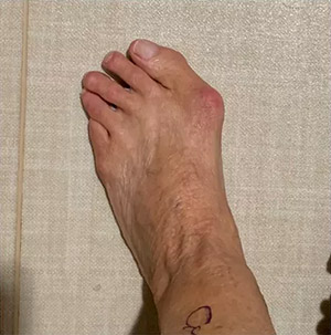 Minimally Invasive Foot Surgery Tacoma, WA | Foot Specialist Seattle, WA